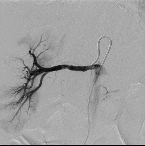 Case Report Renal Artery Dissection At Jessica Myler Blog