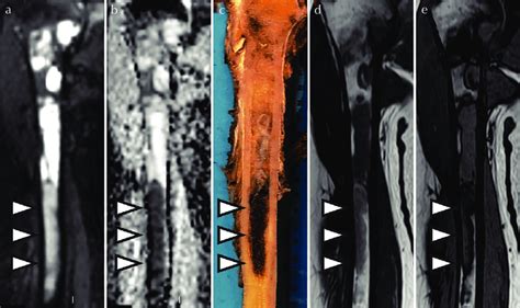 Coronal Diffusion Weighted Imaging Dwi B Value Of 800 Smm 2 A
