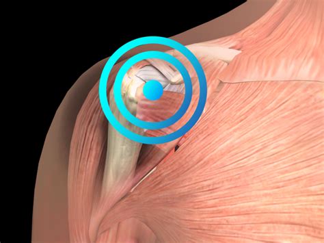 Subacromial Pain Syndrome Ems Dolorclast®