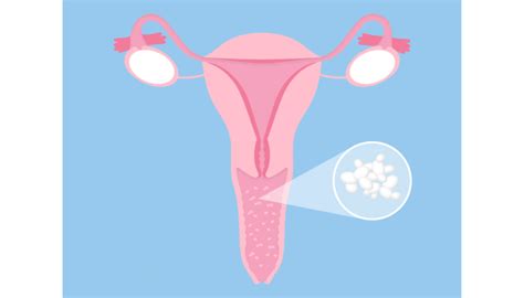 Yeast Infection After Period Is It Possible How To Treat It