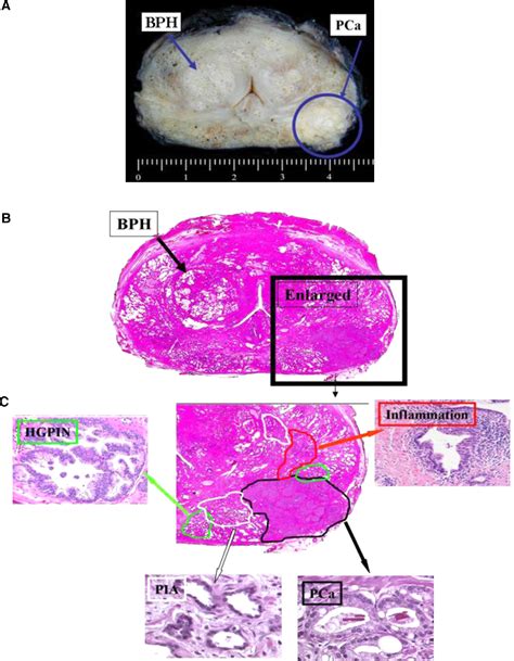 The Controversial Relationship Between Benign Prostatic Hyperplasia And