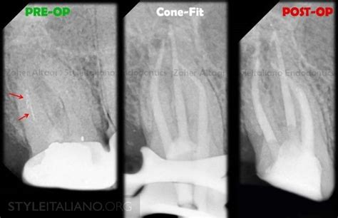 Management Of Broken Files A Clinical Approach Style Italiano