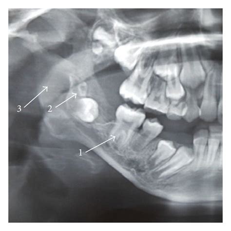 A One Year Follow Up OPG Shows Reduced Tumor Size Arrow B OPG Download Scientific