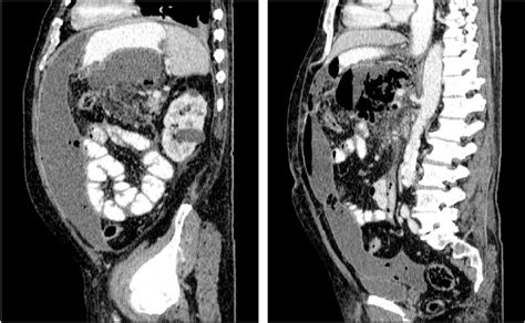 Sagittal View Of The Preperitoneal Collection In The Abdominopelvic Ct