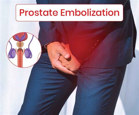Prostate Embolization