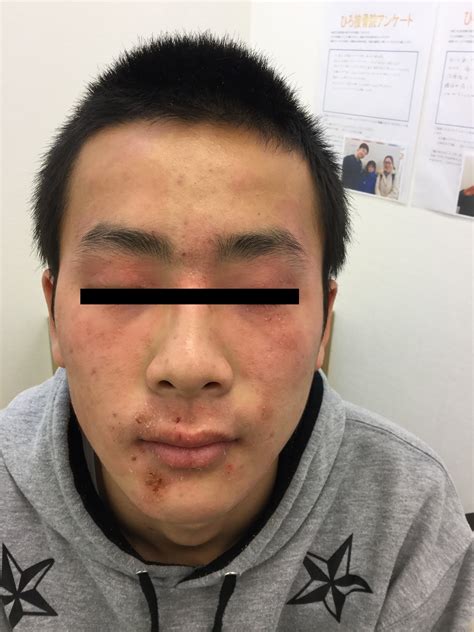 甘い食べ物がアトピーの を引き起こす！？ ひろ接骨院 高槻院