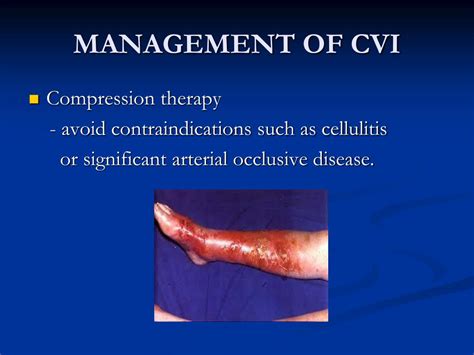 Ppt Chronic Venous Insufficiency Cvi Powerpoint Presentation Free