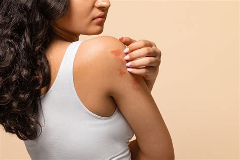 Shingles Vs Other Rashes How To Tell The Difference Wp Mygp Com