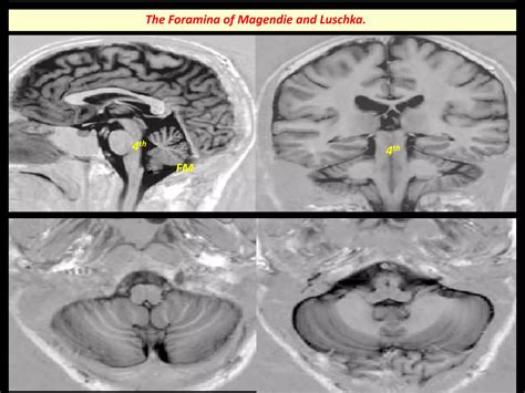 Presentation1pptx Radiological Anatomy Of The Brain And Pituitary