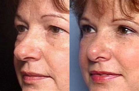 Nose Reshaping Before And After Photos Patient 101 Louisville Ky