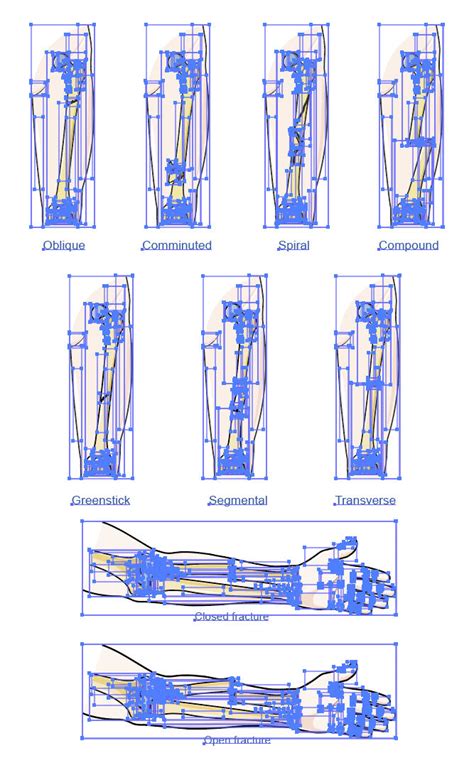 Kind Of Fractures Vector Scientific Illustration