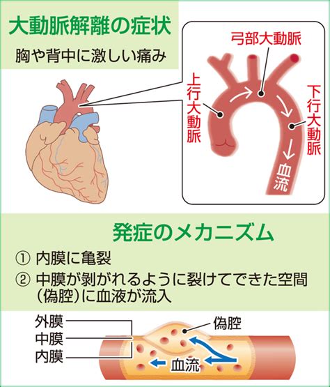 突然胸や背中に激痛走り死亡も、大動脈解離は特に冬注意 笑福亭笑瓶さんら死因、高血圧でリスク高く 医療 福井のニュース 福井新聞online