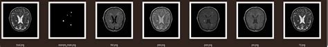 Github Wazhee Automatic Multiple Sclerosis Lesion Tracking Ms Lesion