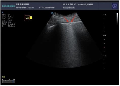 And 6 The Same Patient Hrct Showed Ground Glass Opacity And Reticular