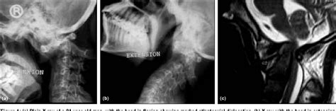 Figure 1 From Craniovertebral Realignment For Basilar Invagination And Atlantoaxial Dislocation