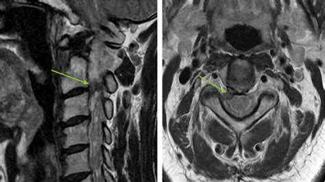 Magnetic Resonance Imaging A Sagittal View Showing A Herniated Disc