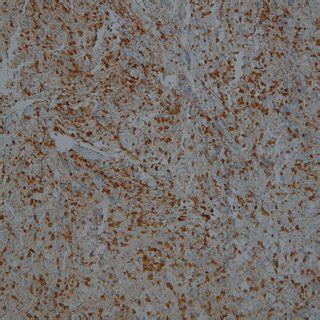 Partial Epidermal Atrophy And The Dense Infiltration Of Atypical