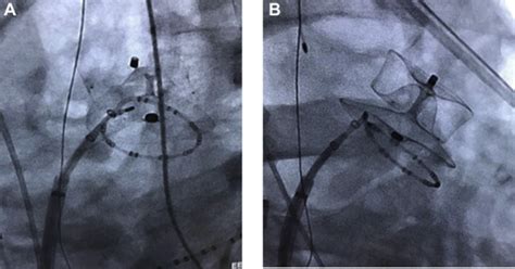 Bilateral Pulmonary Vein Isolation