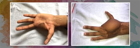Ananta Plastic Surgery A 25 Beded Dedicated Plastic Surgery Centre