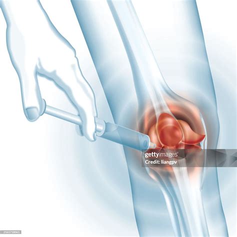 Arthrocentesis Joint Aspiration High Res Vector Graphic Getty Images