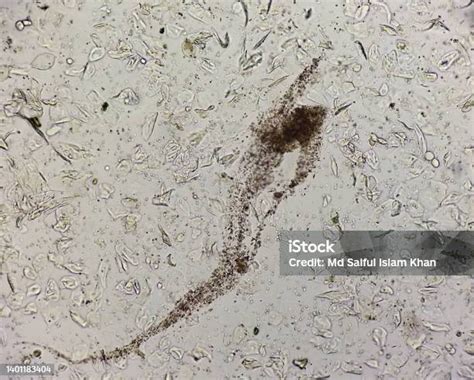 고름 세포와 Rbc로 히알린 캐스트를 보여주는 현미경 소변 검사 0명에 대한 스톡 사진 및 기타 이미지 0명 건강 검진
