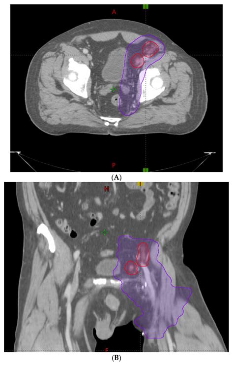 Comparing Outcomes Of Oligometastases Treated With Hypofractionated Image Guided Radiotherapy