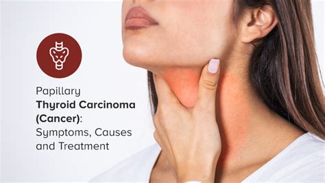 Papillary Thyroid Carcinoma Symptoms Causes Treatment