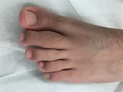 Big Toe Inflammation