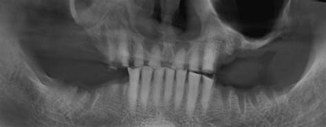 All On X Dental Implants All On 4 Dental Implants Mt Ogden Dental