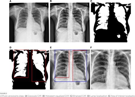 Figure 1 From Unsupervised Domain Adaptation For The Detection Of Cardiomegaly In Cross Domain