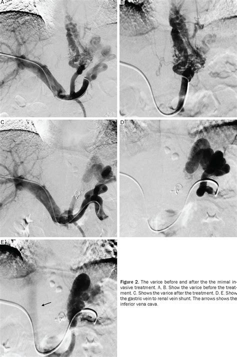 Figure 2 From Percutaneous Transhepatic Embolization Of Gastroesophageal Varices Combined With