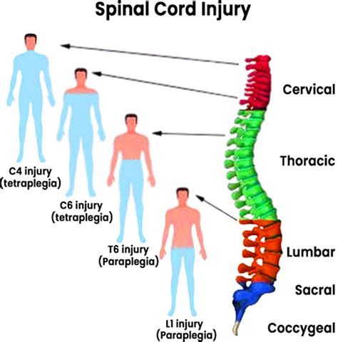 Quadriplegia Or Tetraplegia Meaning Causes Symptoms Diagnosis