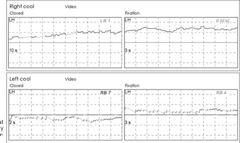 Figure 4 From The 3rd Cranial Nerve Palsy Due To Posterior