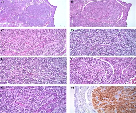 International Journal Of Gynecological Pathology