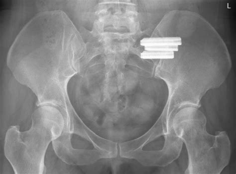Sacroiliac Joint Dysfunction Mri