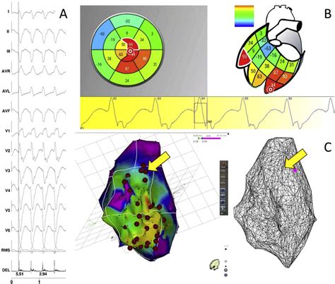 Localization Of Ventricular Tachycardia Patient 1 Download Scientific Diagram