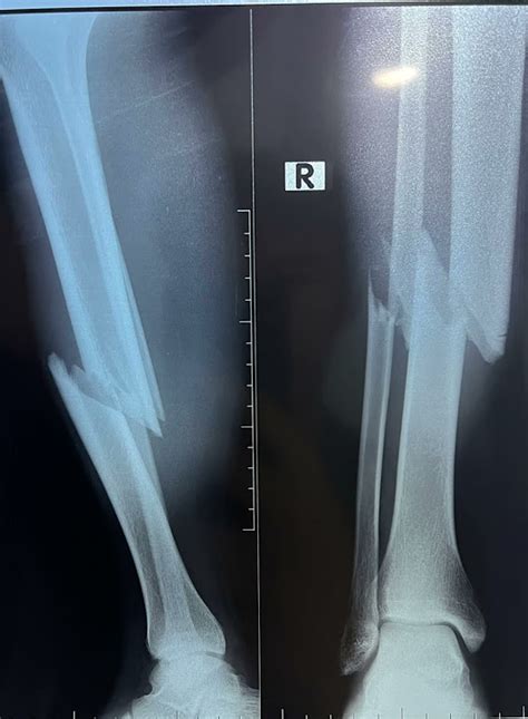 វះកាត់ ឆ្អឹង បាក់បែក Youtube