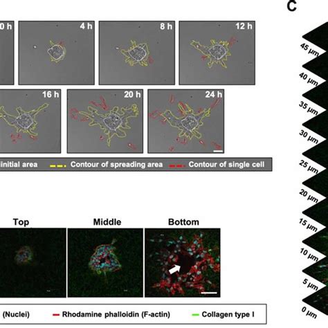The Migration And Invasion Patterns Of Breast Tumor Spheroids At The