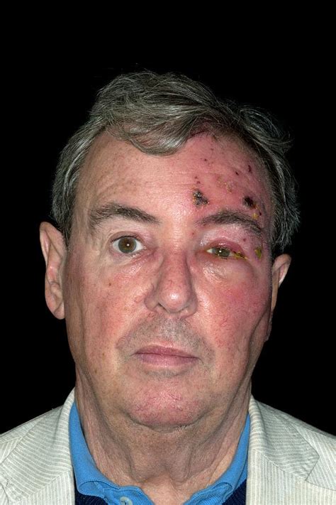 Shingles Symptoms
