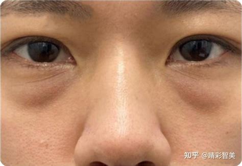 睛彩智美案例分享论去眼袋的重要性和我信赖的热熔技术 知乎