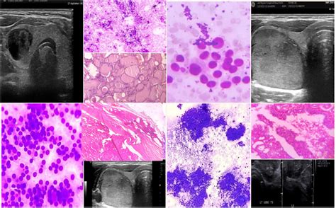Correlation Of Ultrasound‐based Tirads And The Bethesda System For