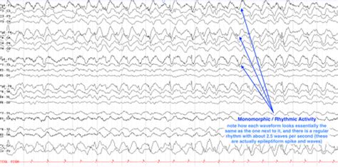 Eeg Terminology And Waveforms
