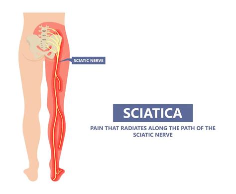 Explained How To Sit With Sciatica Lakewood Co Postureworks