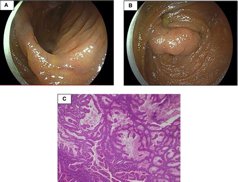 Double Balloon Enteroscopy Revealed Two Polyps With Diameters Of 20 And Download Scientific