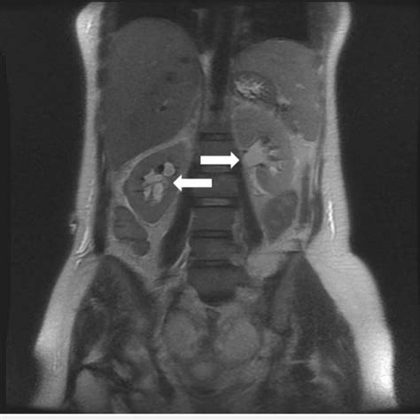 Coronal T2 Weighted Mri Of The Abdomen Demonstrating Dilatation Of The