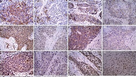 Immunohistochemical Staining Of Esophageal Lesions With Hla I Antigen