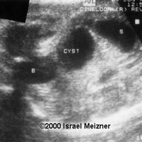 Cysts In Uterus Ultrasound