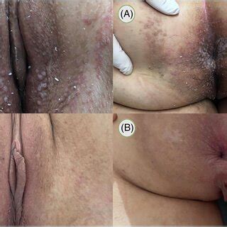 PDA Affecting Patient S Vulva And Perianal Area A Pretreatment B Download Scientific