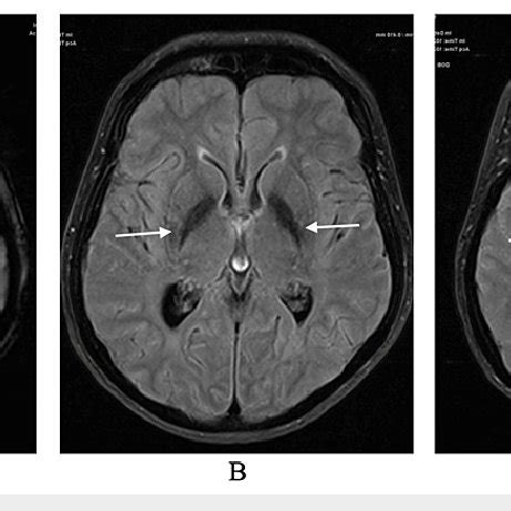 Image A Is Showing Blooming Artifact On Susceptibility Weighted Images