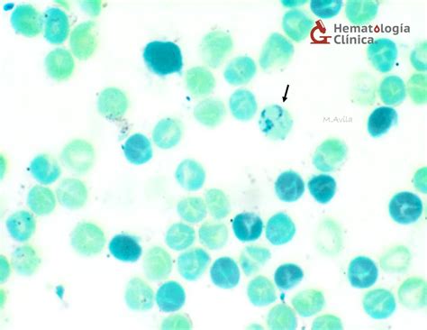 👉los Reticulocitos Representan A Hematología Clínica